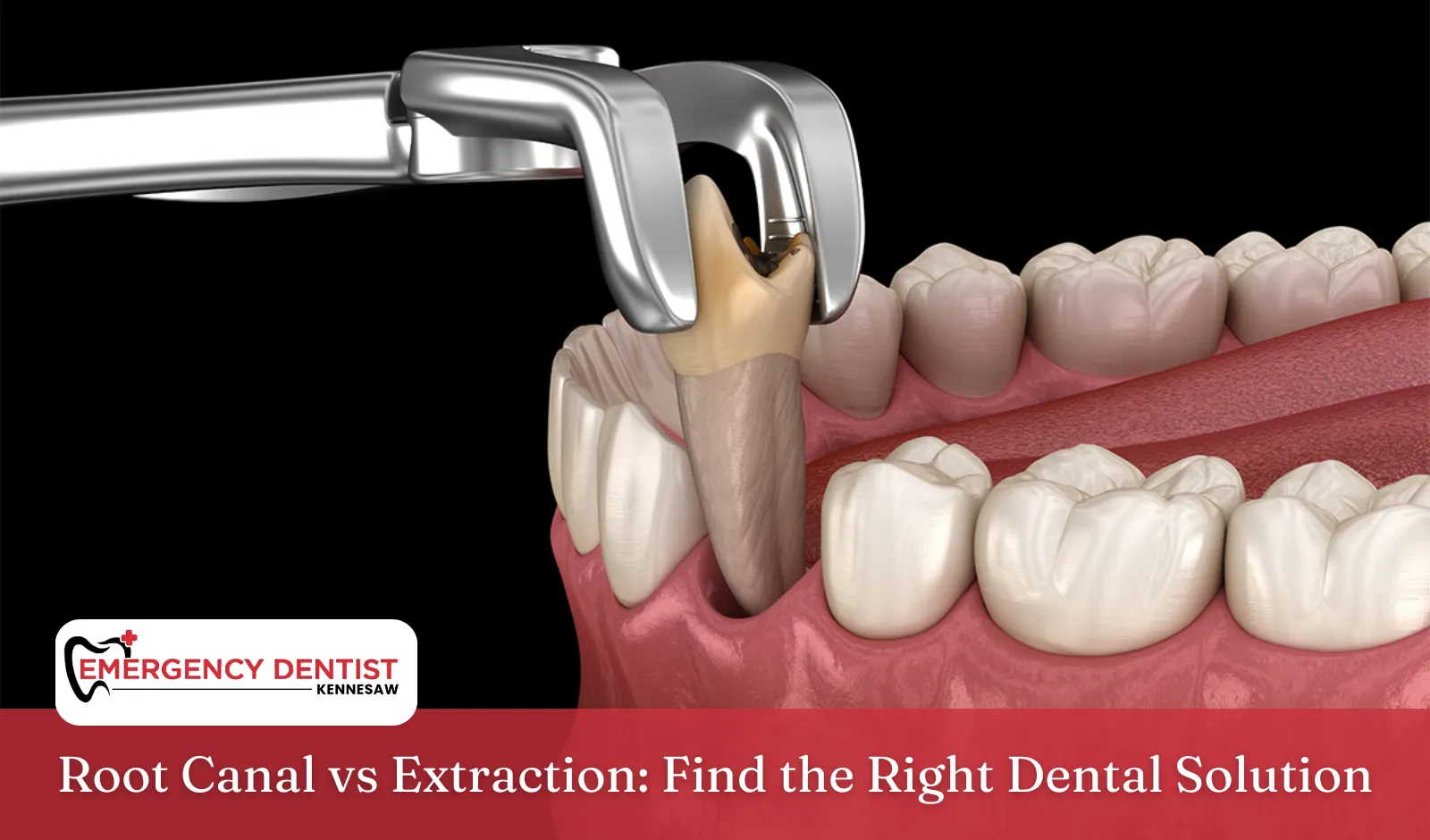 Root Canal vs Extraction: Find the Right Dental Solution