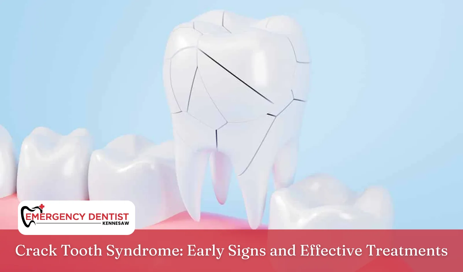Crack Tooth Syndrome: Early Signs and Effective Treatments